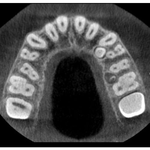 CARESTREAM CS 9300 SELECT PANOREX + CONE BEAM | HampMED