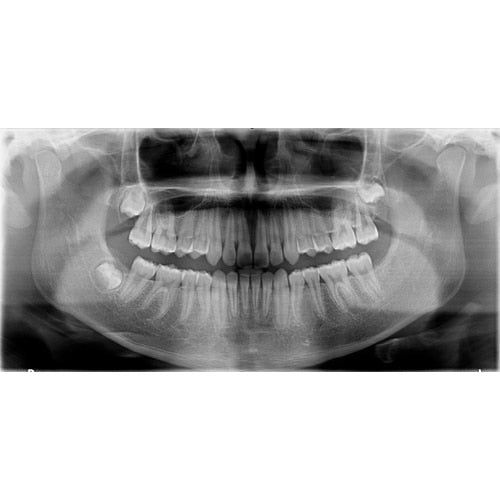 CARESTREAM CS 9300 SELECT PANOREX + CONE BEAM | HampMED