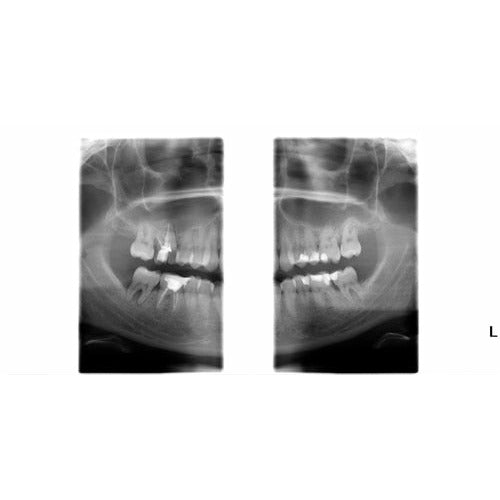 INSTRUMENTARIUM OP300 MAXIO PANOREX + CONE BEAM | HampMED